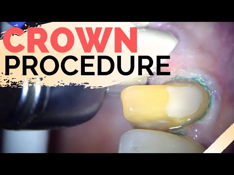 Dental Crown Explained | Anterior Crown Preparation