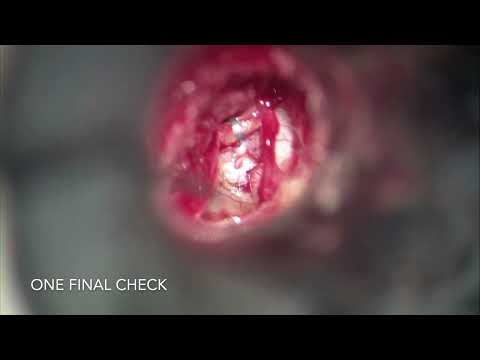 Stapes Surgery (Stapedectomy/Stapedotomy) for Otosclerosis by Dr. Neal Jackson