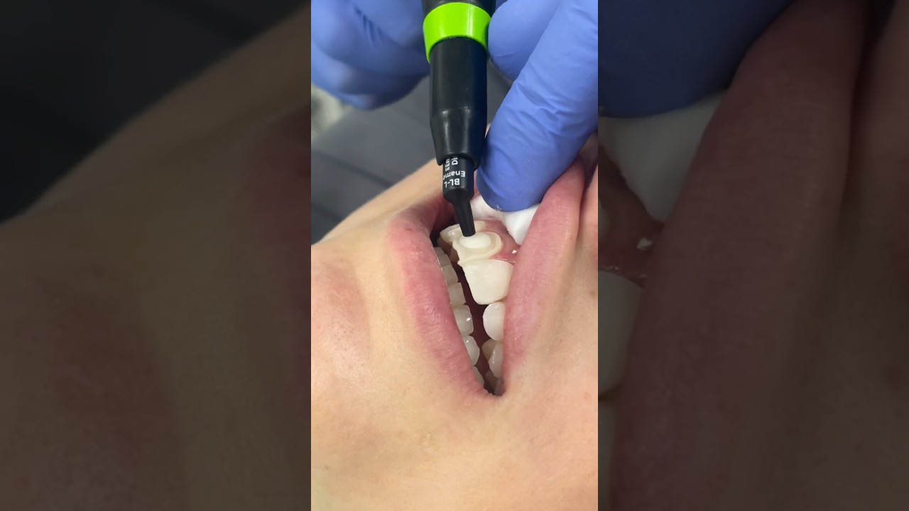 Composite bonding by Dr. Charlie. 👏 #ruhdental #compositebonding