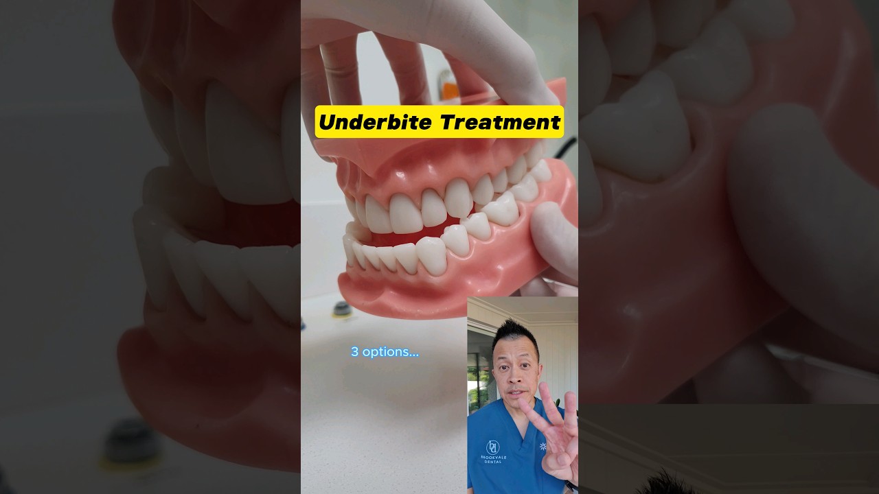 Transform Your Smile: 3 Underbite Correction Options You Need to Know! #shorts #dentallan