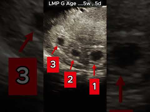 Early Triple Pregnancy - after Ovulation Medications #ultrasound #pregnant #baby #pcos