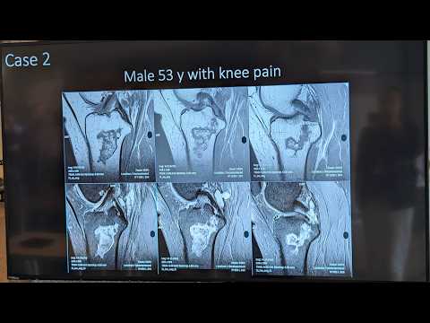 How An MSK Expert Tackles a Complex Knee MRI