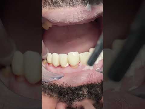 Zirconia crowns and bridge to protect root canal treated teeth #dentist