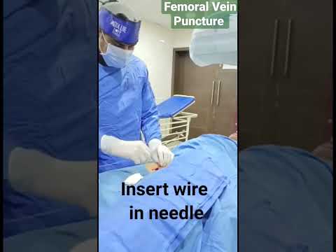 Femoral vein puncture ( for Temporary pacemaker) #pacing #shorts
