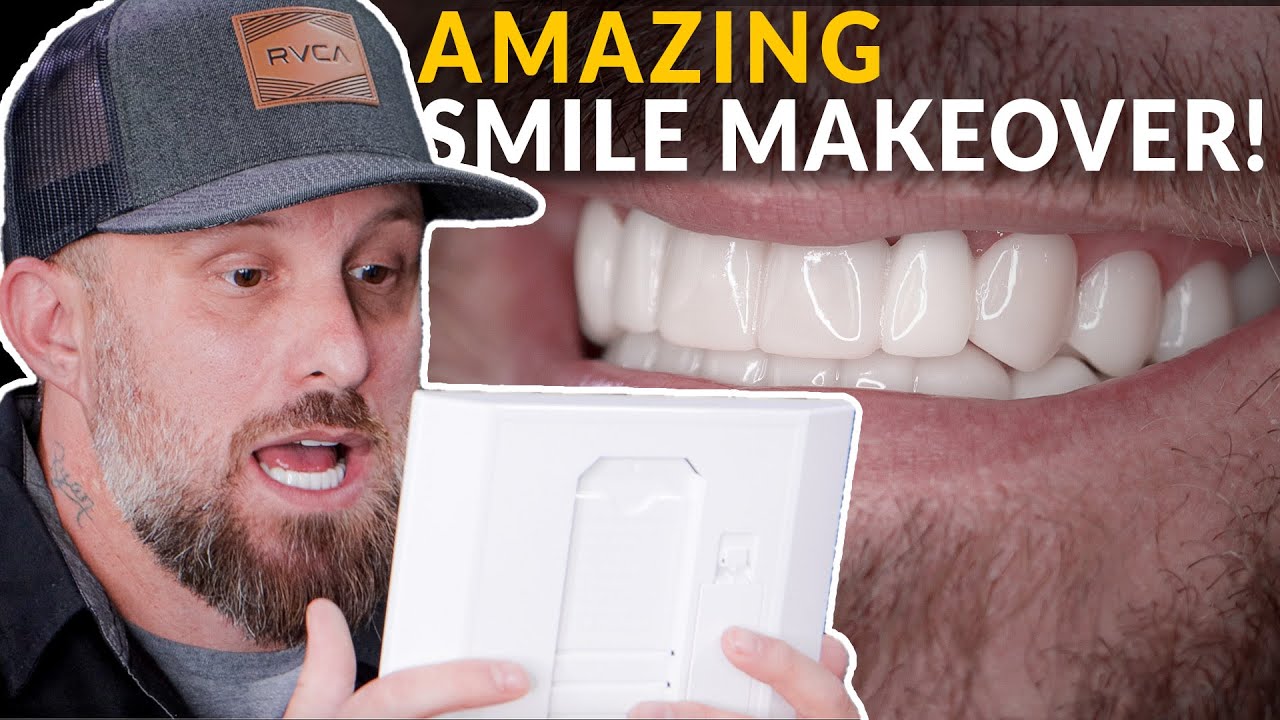 New Smile Makeover Reveal! The Best Cosmetic Dentistry Alternative