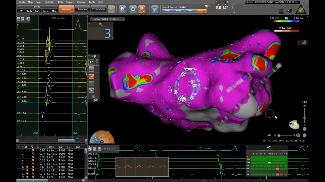 Electroanatomical mapping of the left atrium