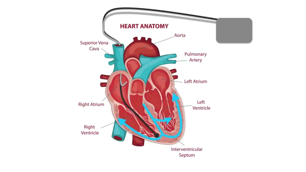 Common pacemaker problems part 2： Undersensing
