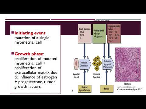 Myoma uteri – Doc Ina Ob Gyne