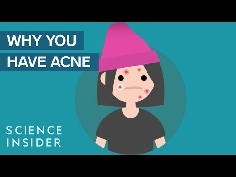 Why You May Have More Acne Than Other People