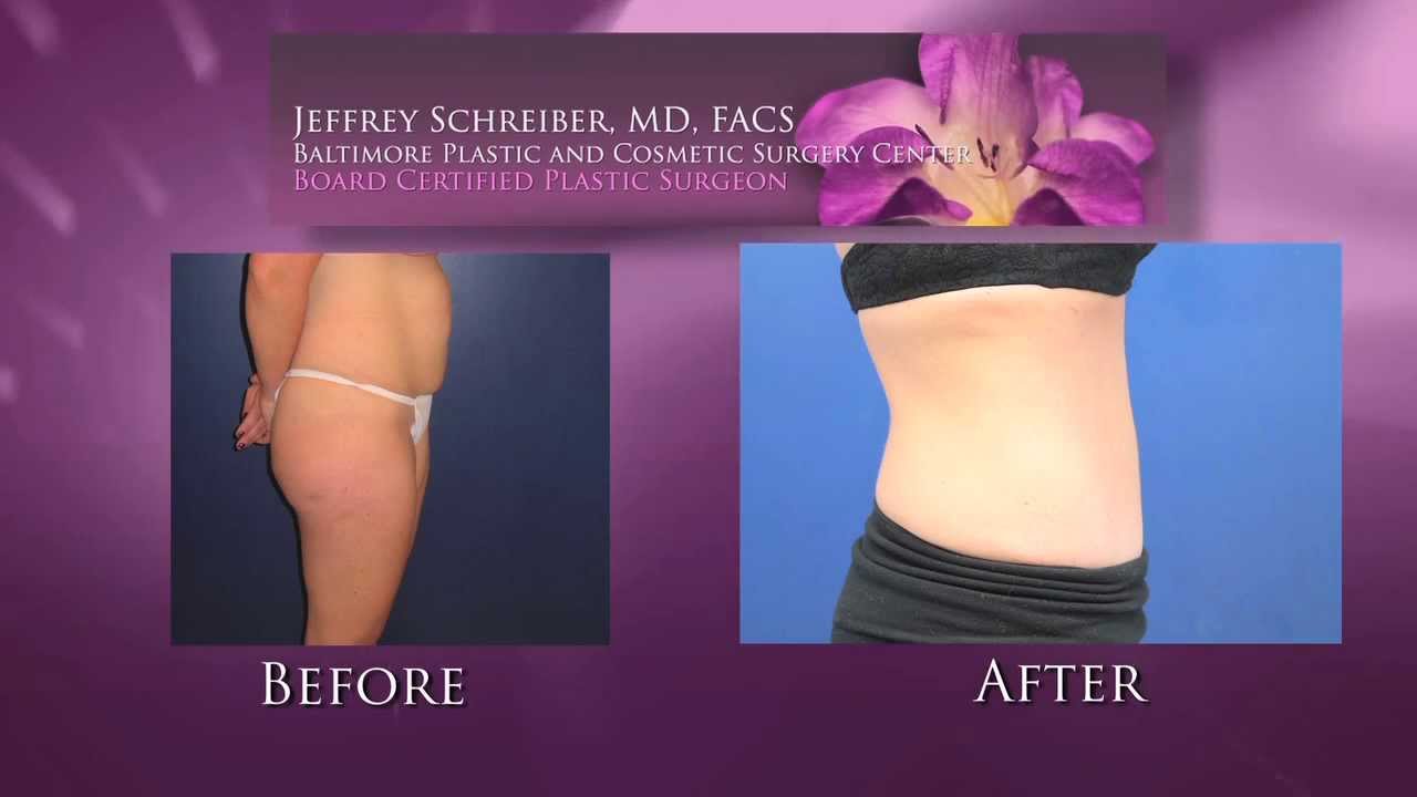 Baltimore tummy tuck video