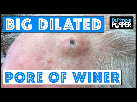 Dr. Pimple Popper's 10 Best Dilated Pore of Winer Videos