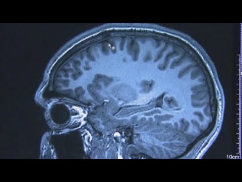 How to tell the difference between Alzheimer's Disease and Dementia