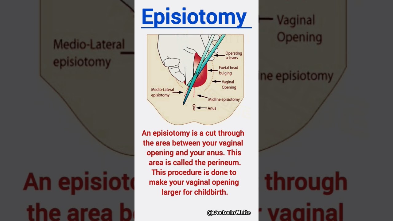 Episiotomy | #viralvideos #episitomy #obstetrics #gynecology