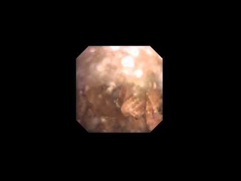 Renal Calculi with the New Odyssey 30