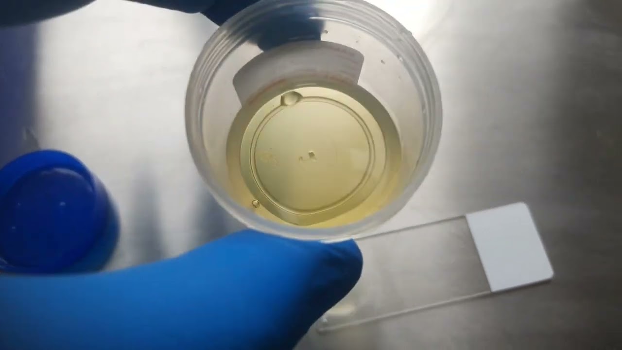 Parasite in Urine Microscopy | Egg of Pinworm |Enterobius vermicularis