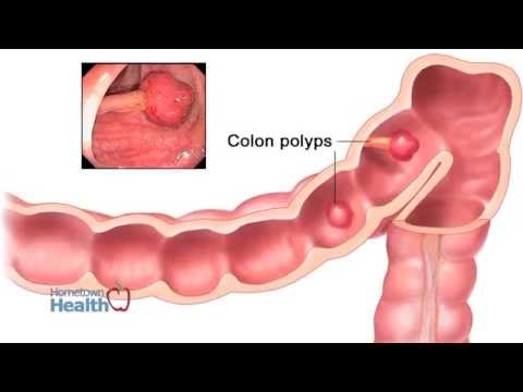 Advanced Gastroenterological and Surgery Associates - Colon Screening