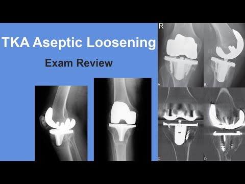 TKA Aseptic Loosening Exam Review - Thomas Sculco, MD