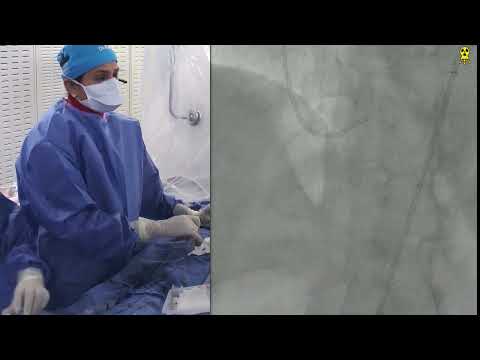 Complex RA of Severely Calcified Circumflex - December 2023