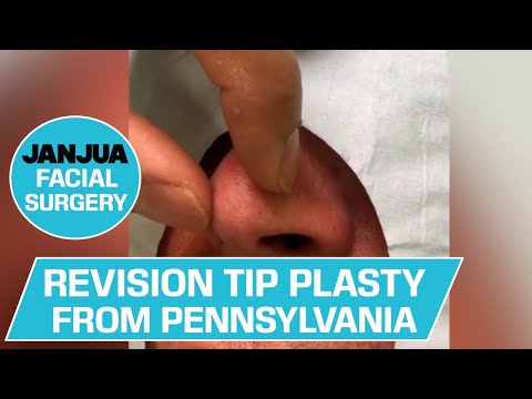 REVISION TIP PLASTY FROM PENNSYLVANIA - DR. TANVEER JANJUA - NEW JERSEY