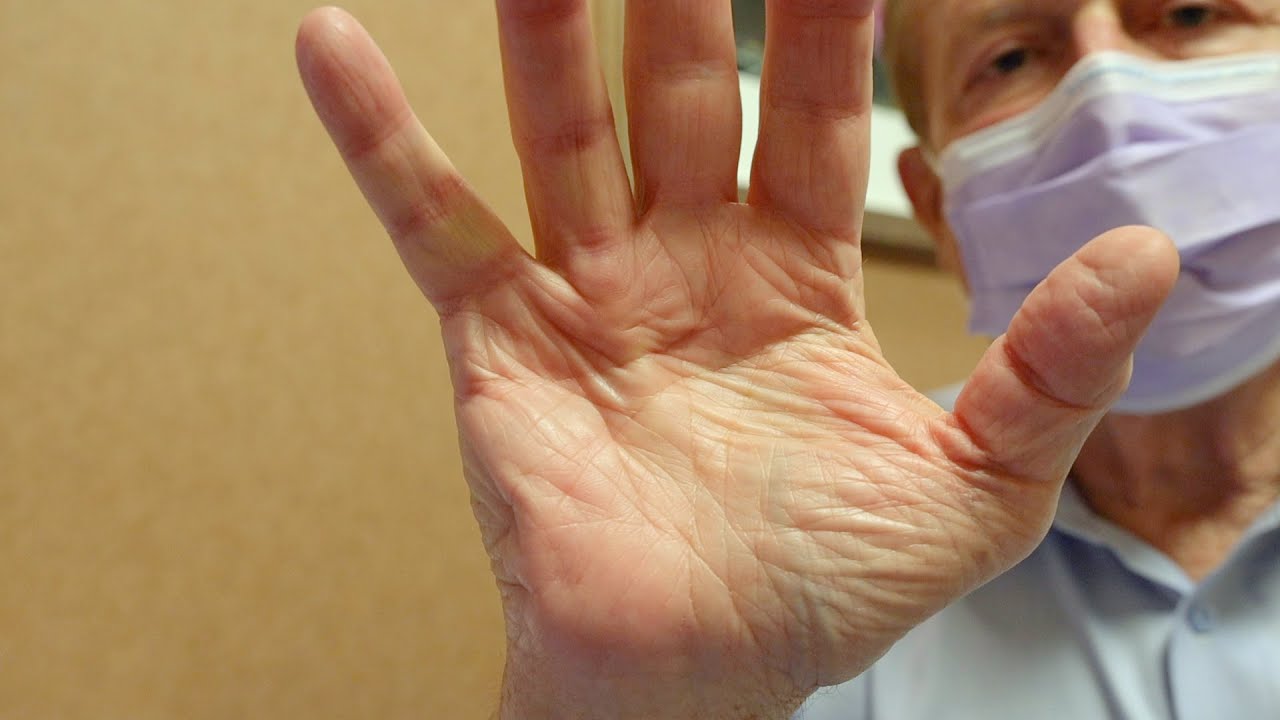 Mayo Clinic Minute - Treating Dupuytren’s contracture without surgery