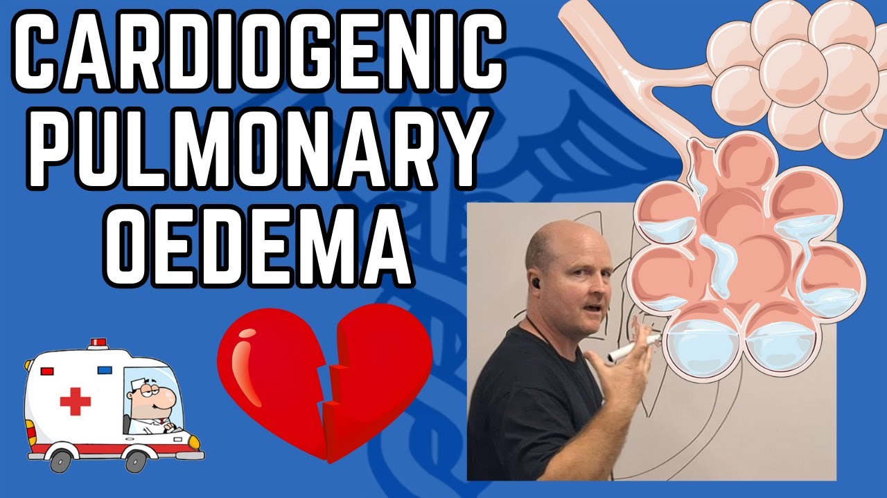 Cardiogenic Pulmonary Oedema Explained