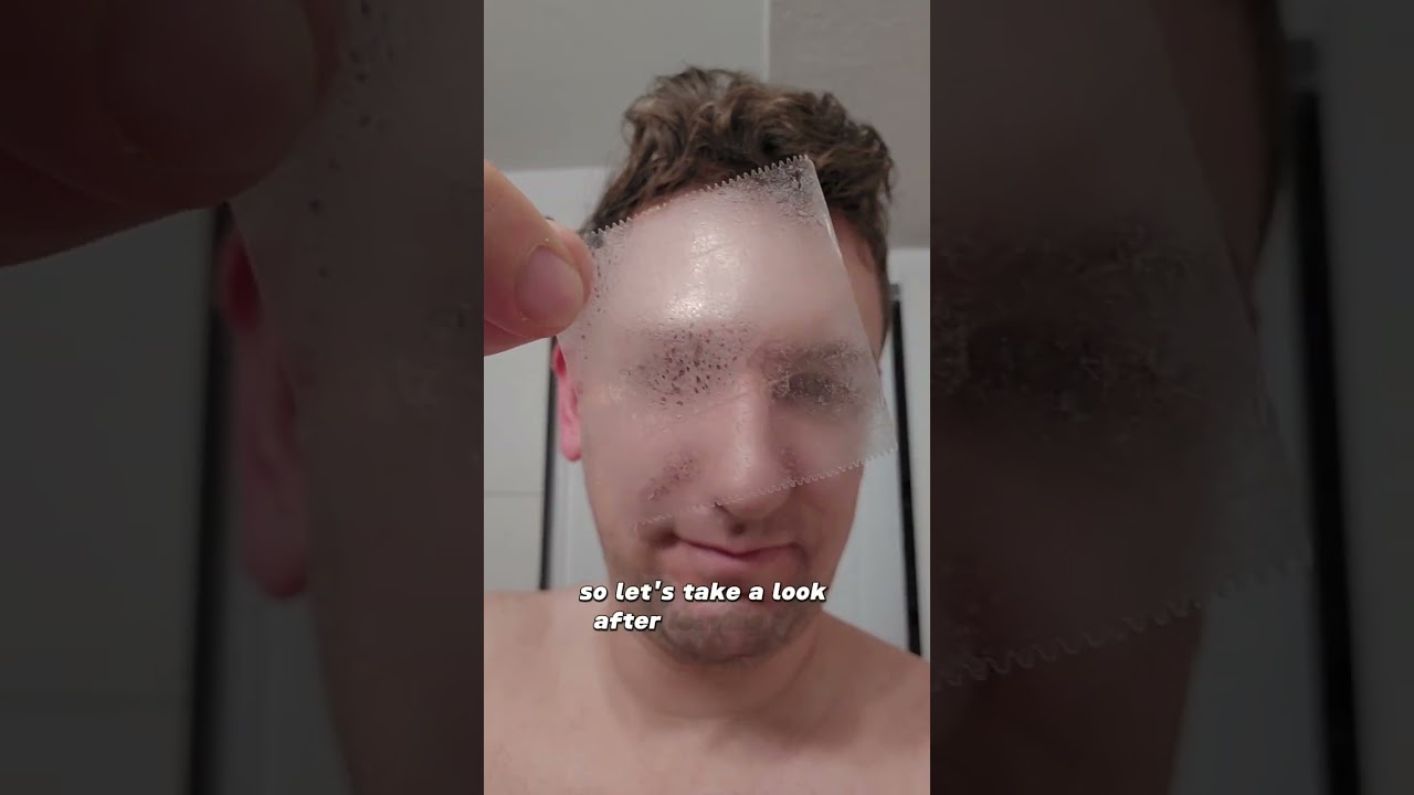 Finding out what's LIVING IN MY PORES: Dermatologist does tape test #demodex #mites #skin #derm