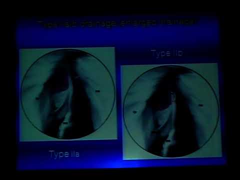 Wolfgang DRAF lecture: Frontal Sinus approaches