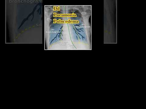 pneumonia diagnosis by air broncogram xray #tapesh