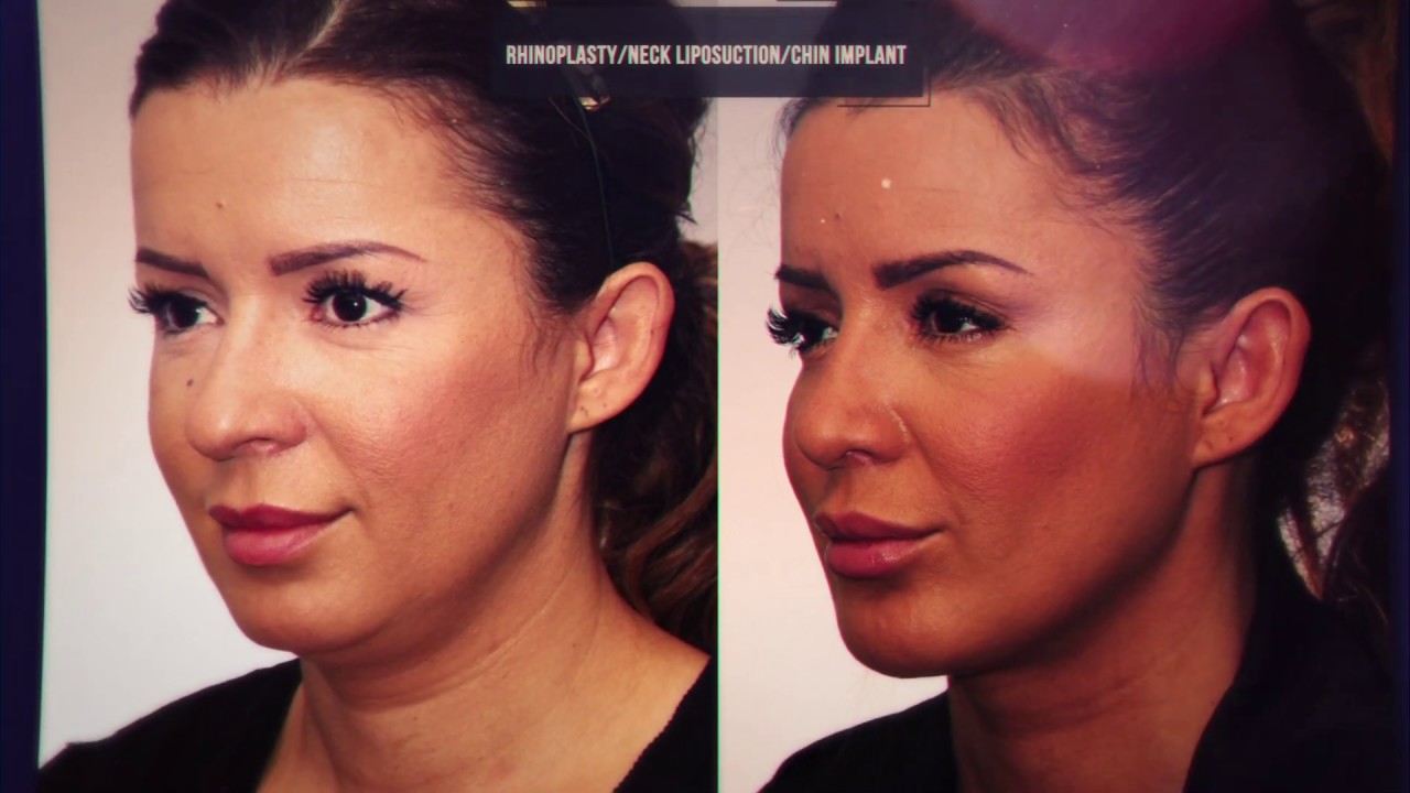 Solomon Facial Plastic Before After Series #41