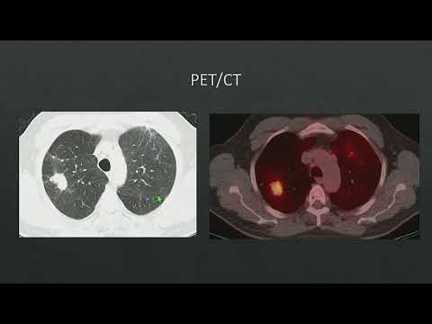 Pneumoconiosis