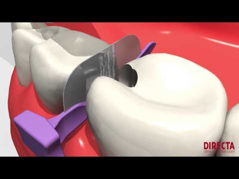 FenderMate® Temp by Directa - protection and matrix for temporary restorations