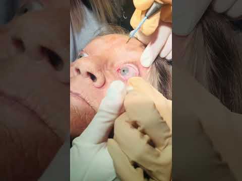 Conjunctival cyst removal-part 1 #shorts #cyst #youtubeshorts #shortvideo #shortsfeed #shortsviral