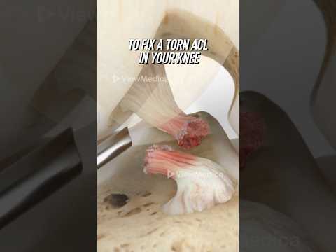 ACL reconstruction using your own tendon (3D Animation)