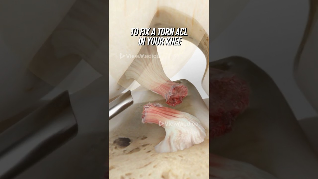ACL reconstruction using your own tendon (3D Animation)