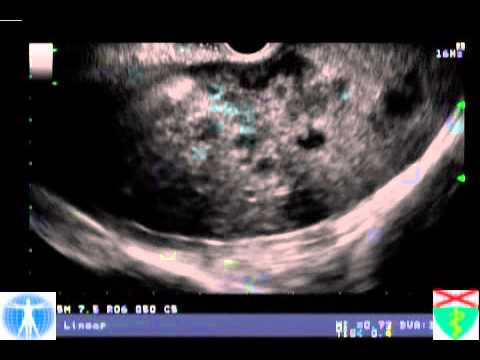 Biliary -- Multiple Liver Microabscesses in Malignant Biliary Obstruction; EUS
