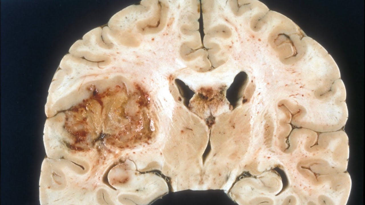 USMLE Q | #60 | Neurology