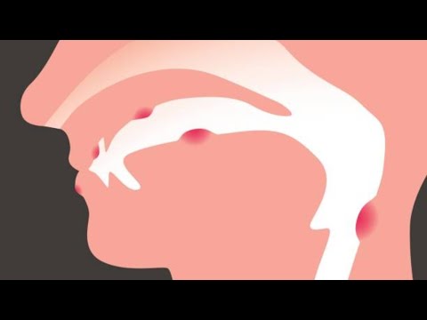 Oral Mucosal Disease
