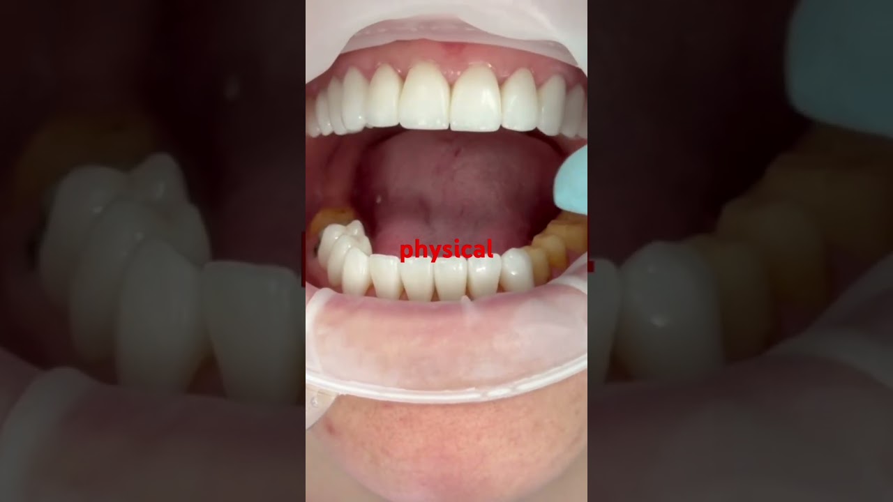 Process for full mouth lower from upper which is we made one year ago! Dr.John Vargas New York