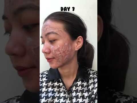Progress laser co2 fractional kedua | berapa hari pengelupasan laser co2 ?