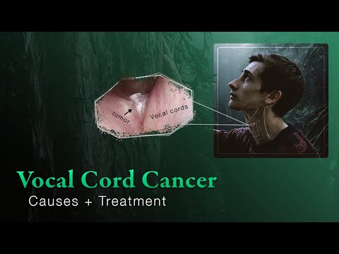 Early Vocal Cord Cancer | Introduction and Treatment Options