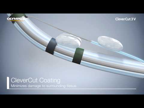 Distal Wire-Guided Sphincterotomes I ERCP Procedure I CleverCut 3V