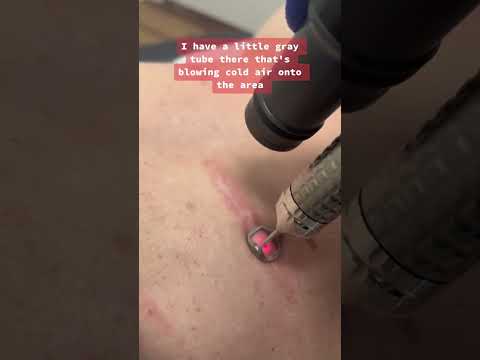 Laser Scar Revision
