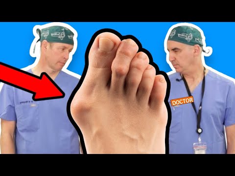 Bunions: Causes and Treatments