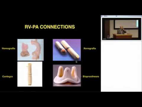 Mgmt Of Post Operative Patients W Tetralogy Of Fallot Garbose Lecture Hellenbrand 5 11 16 1