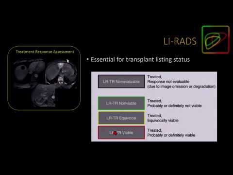 What’s New in LI-RADS?-- Kathryn Fowler, MD (SABI 42nd Annual Course)