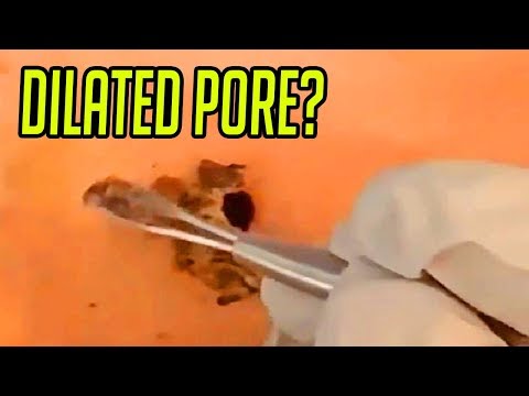 Dilated Pore of Winer?  What is it?