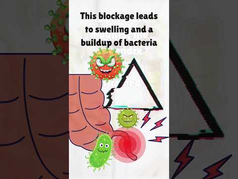 What is Appendicitis Explained: Causes, Symptoms, and Treatment in 30 seconds!