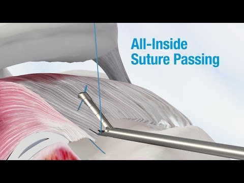 Spectrum® AutoPass™ Suture Passer - CONMED Product Video