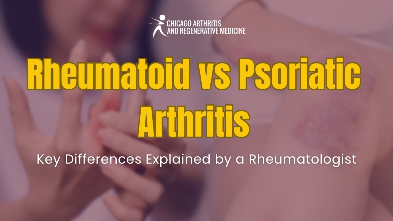 Rheumatoid vs Psoriatic Arthritis: Key Differences Explained by a Rheumatologist - Chicago ...