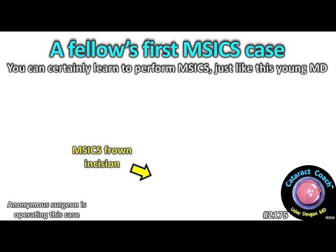CataractCoach™ 2175: A fellow's first MSICS cataract surgery